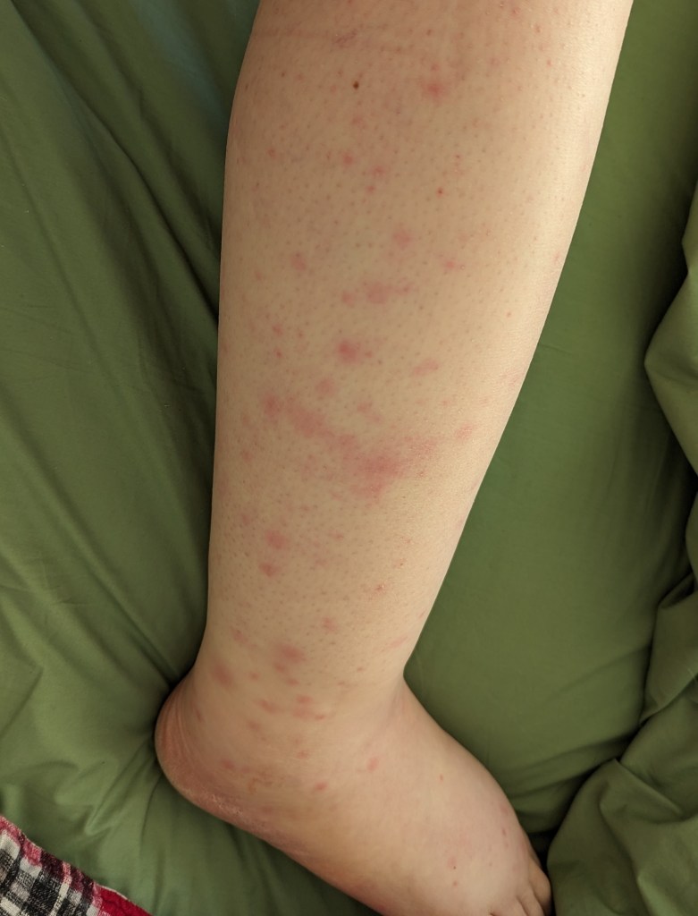 Seeing Red: My First Encounter with Cellulitis
