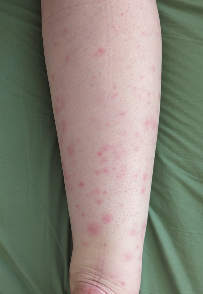 Seeing Red: My First Encounter with Cellulitis