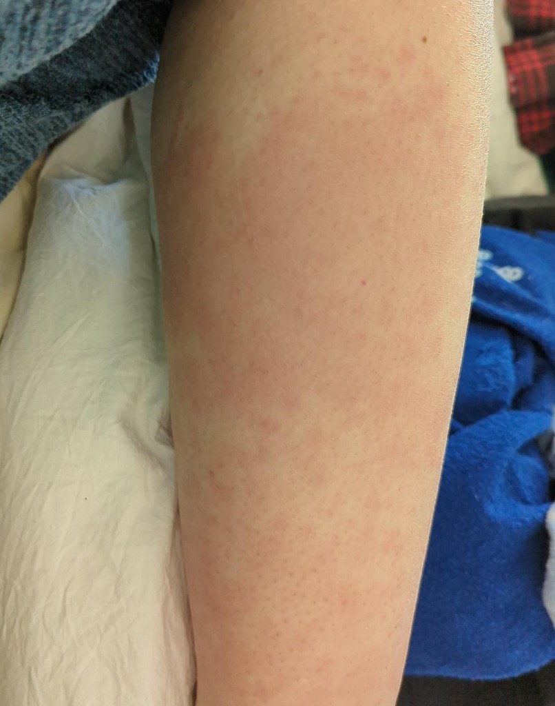 Seeing Red: My First Encounter with Cellulitis