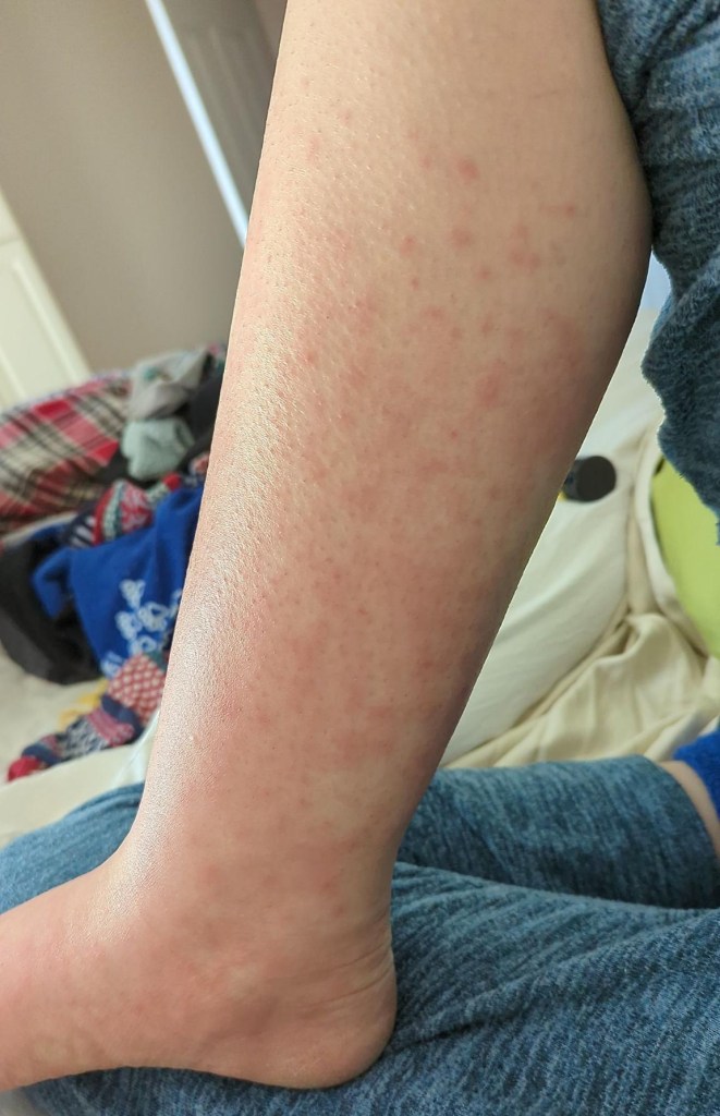 Seeing Red: My First Encounter with Cellulitis